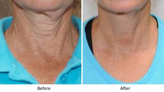 Lasers | Bernardo Dermatology Medical Group